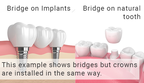 Dentist for Dental Crowns & Bridges in West Palm Beach, Florida